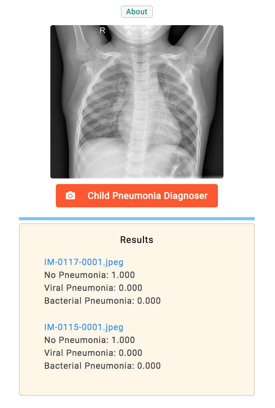 Pneumonia X Ray Child Pneumonia Wikipedia