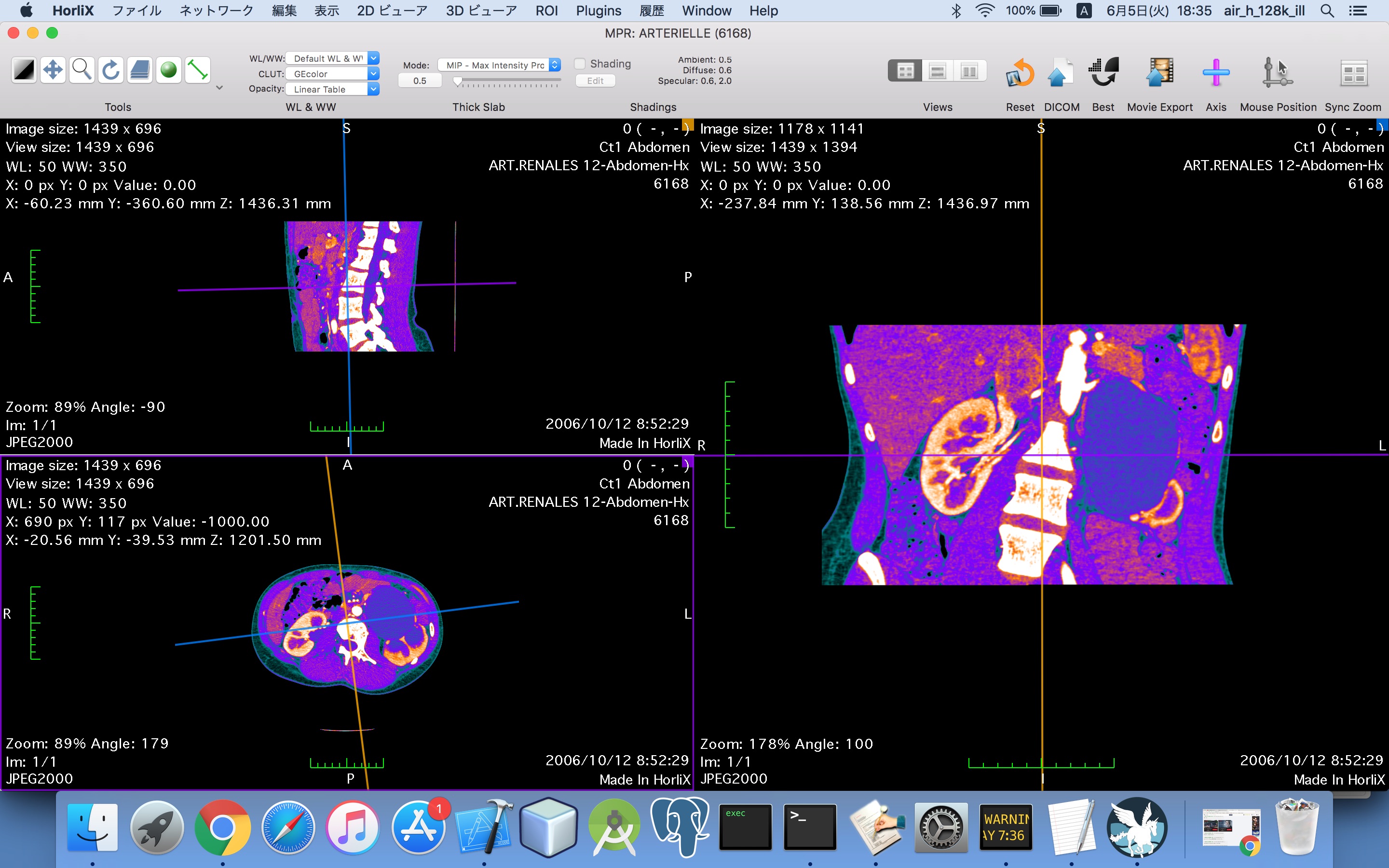 GitHub - Hiroaki-Inomata/HorliX: HorliX は Horos / OsiriX ベースの画像ビューアです
