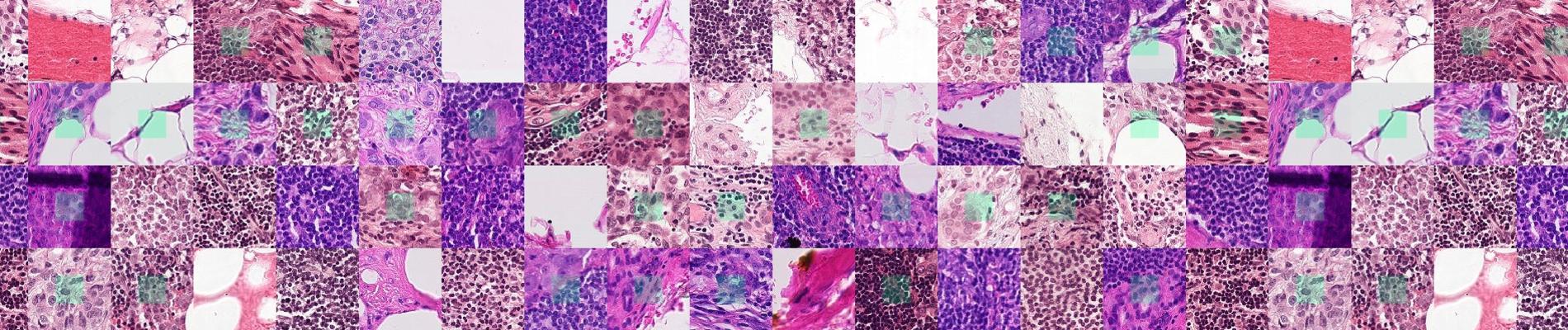 Github Acambray Cancerous Tissue Detection Cnn Implementation Of A Lymph Node Bening
