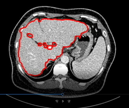 GitHub - JasonChennn/Applied-to-Liver-Segmentation-using-OpenCV: 一個基於Python的傳統影像處理演算法，主要透過OpenCV ...